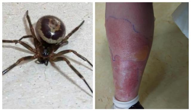 black widow babies bite